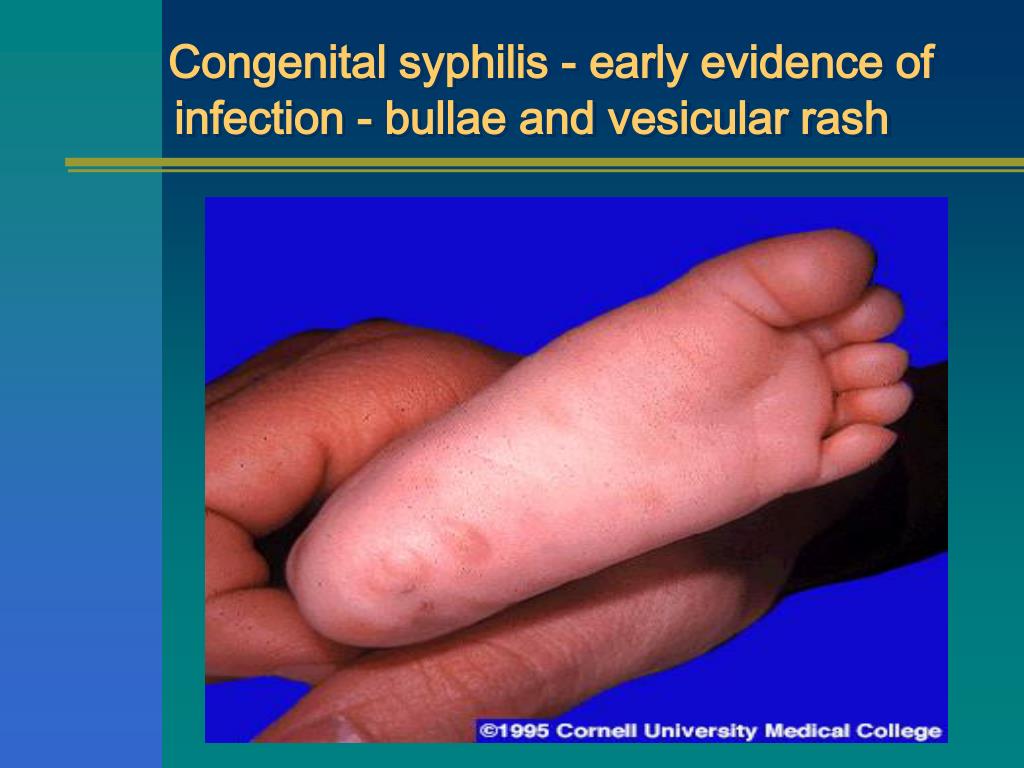 Ppt Congenital Syphilis Powerpoint Presentation Free Download Id