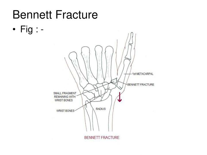 PPT - Injuries to the wrist PowerPoint Presentation - ID:870242