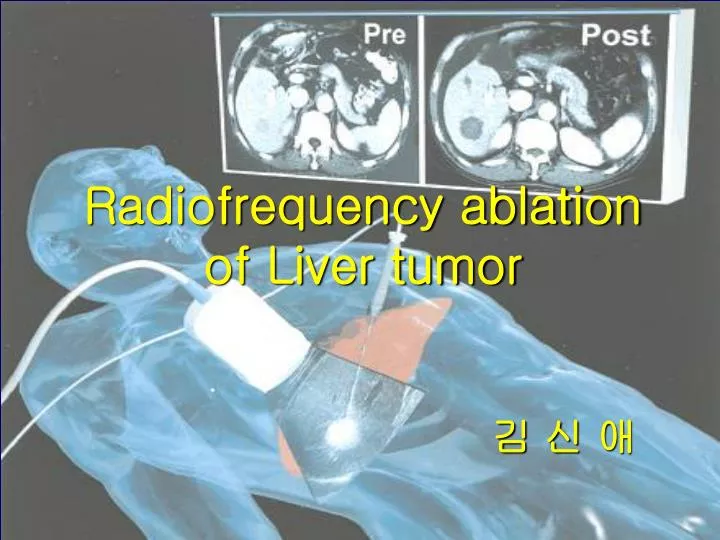 PPT - Radiofrequency ablation of Liver tumor PowerPoint Presentation ...