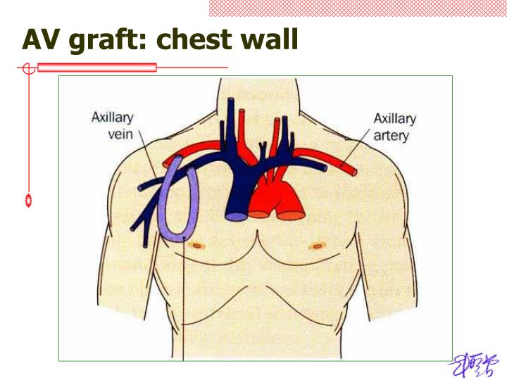 PPT - 血管通路的建立與維護 The creation and maintenance of hemodialysis vascular ...