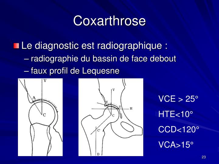 PPT - ARTHROSE PowerPoint Presentation - ID:877441