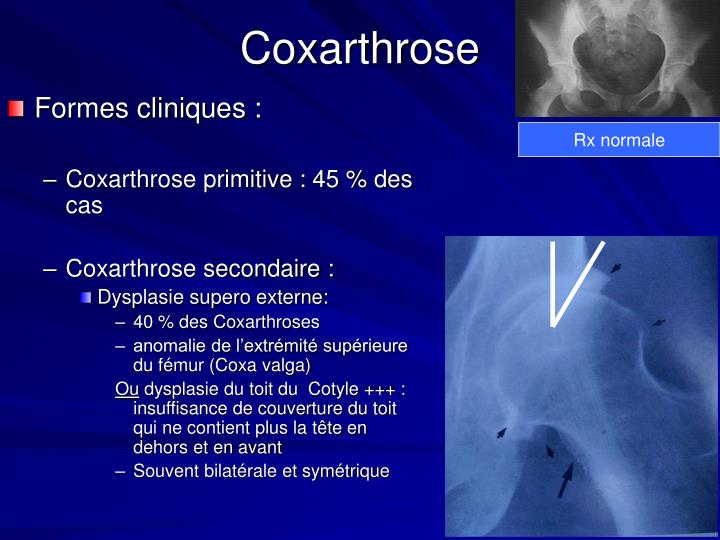 PPT - ARTHROSE PowerPoint Presentation - ID:877441