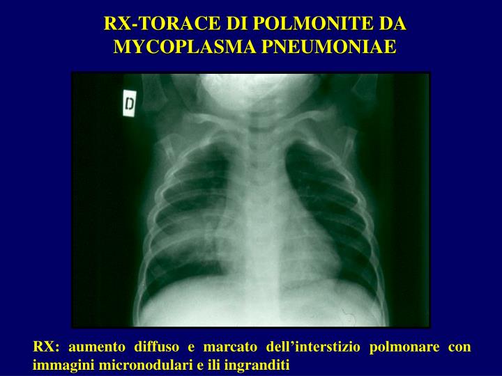 PPT - POLMONITE DEFINIZIONE PowerPoint Presentation - ID:877871