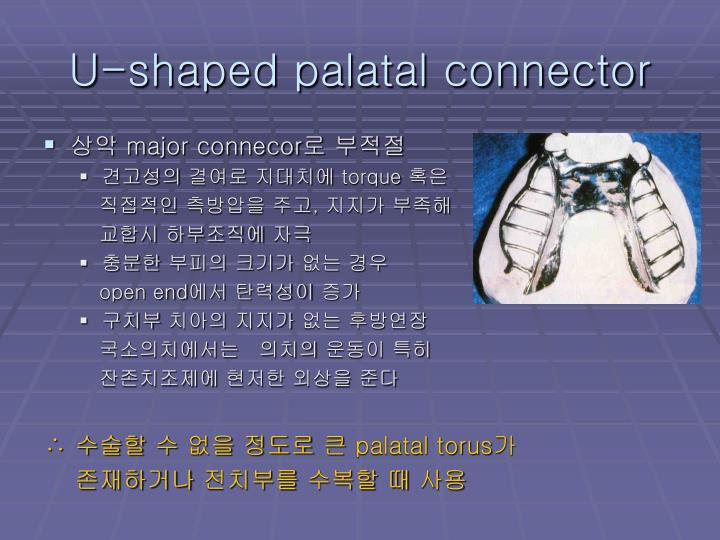 PPT - 상악 RPD 설계 PowerPoint Presentation - ID:882425