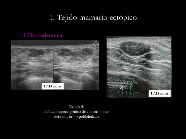 PPT - Estudio de la axila en una sección de mama PowerPoint ...
