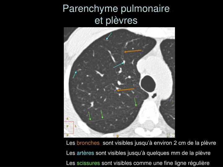 PPT - SCANNER THORACIQUE NORMAL PowerPoint Presentation - ID:887650