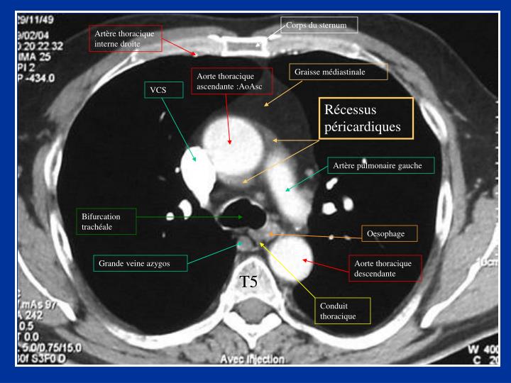 PPT - Scanner thoracique Anatomie du thorax en coupes PowerPoint ...