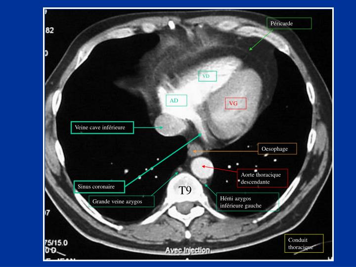 PPT - Scanner thoracique Anatomie du thorax en coupes PowerPoint ...