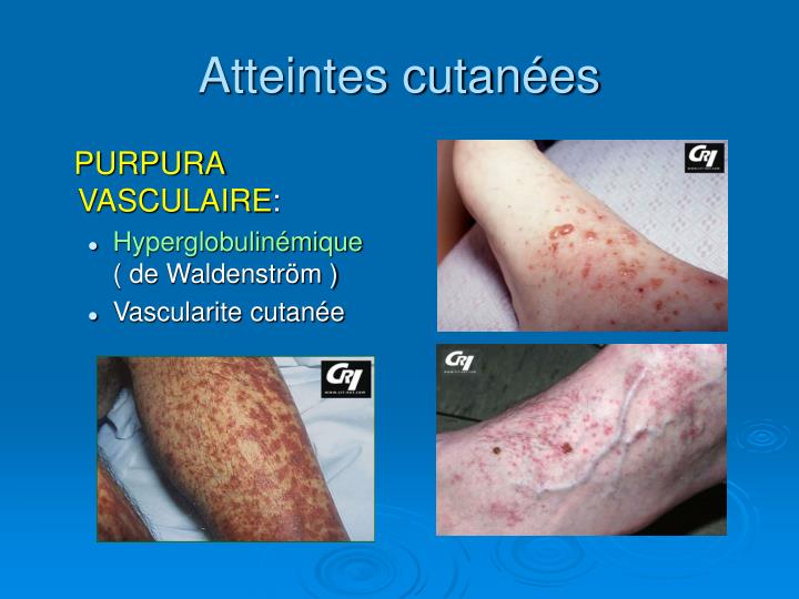 PPT - SYNDROME de GOUGEROT-SJÖGREN PowerPoint Presentation - ID:897055