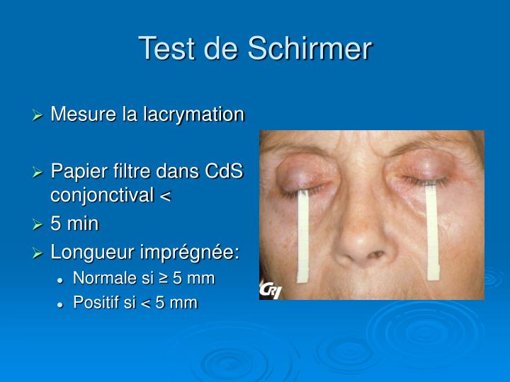 PPT - SYNDROME de GOUGEROT-SJÖGREN PowerPoint Presentation - ID:897055