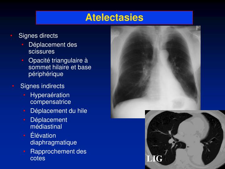 PPT - LA RADIOGRAPHIE THORACIQUE PowerPoint Presentation - ID:897739