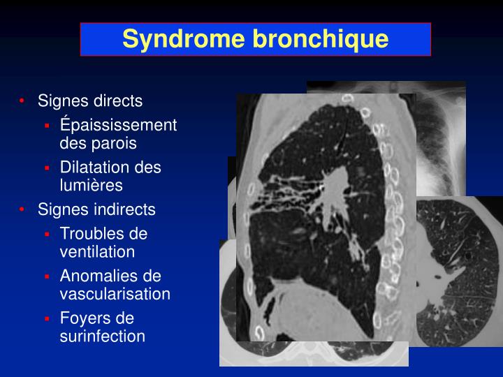 PPT - LA RADIOGRAPHIE THORACIQUE PowerPoint Presentation - ID:897739