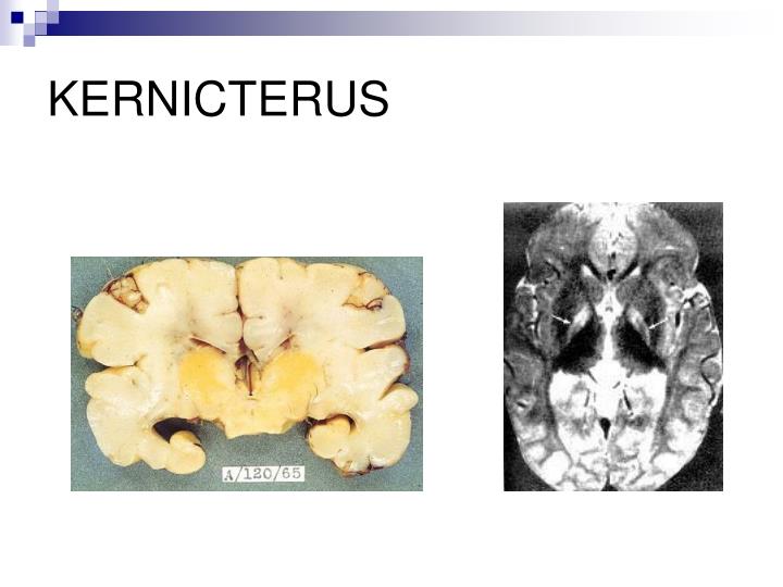 PPT - KERNICTERUS PowerPoint Presentation - ID:898577