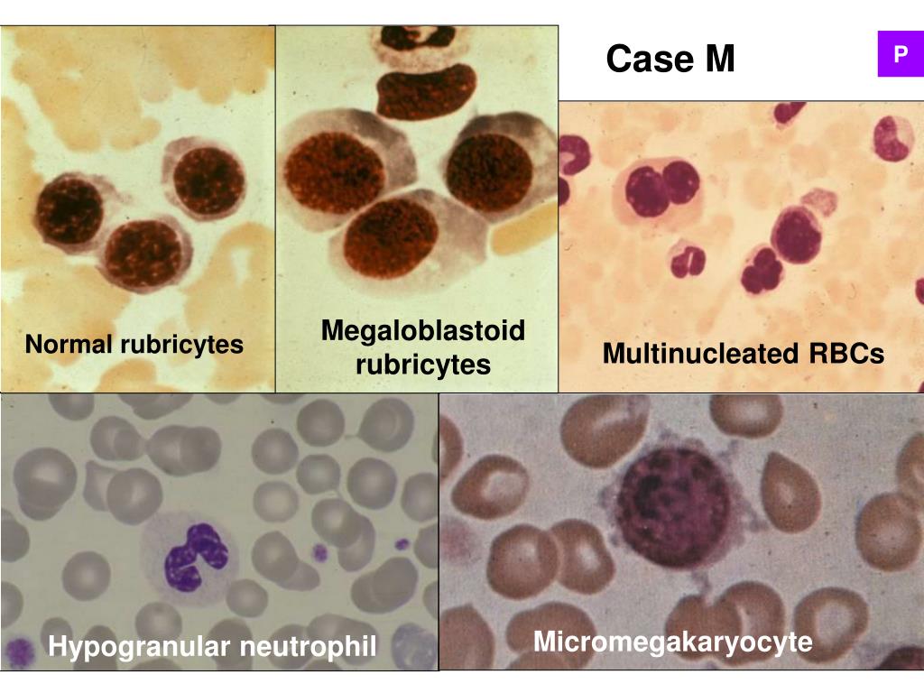 PPT - MT417 - CLINICAL HEMATOLOGY II Linda Sykora, MT(ASCP)SH ...