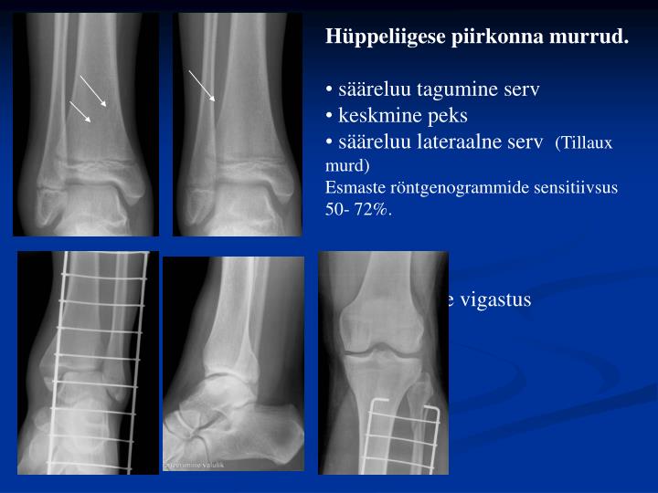PPT - LUUMURDUDE PILTDIAGNOSTIKA. Karin Veske SA TÜK Maarjamõisa ...