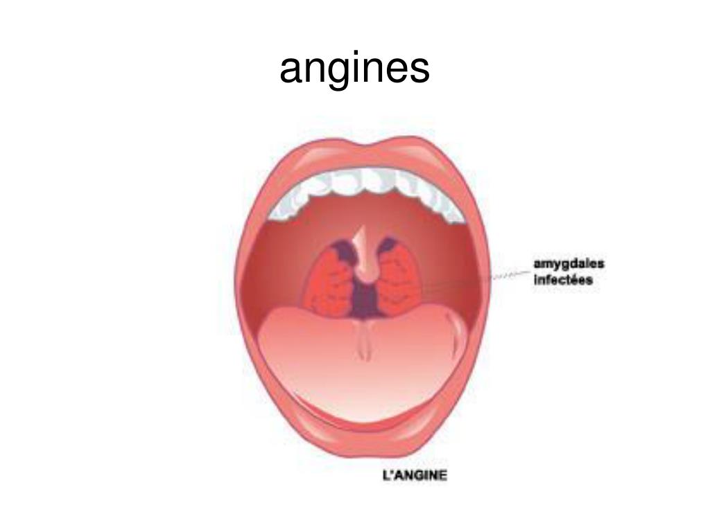 PPT - Infections ORL et bronchiques du jeune enfant PowerPoint ...