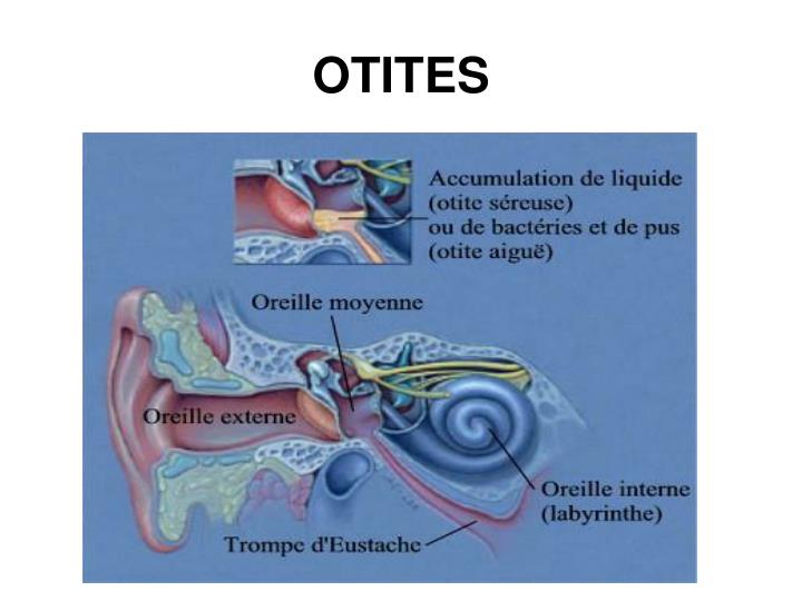 PPT - Infections ORL et bronchiques du jeune enfant PowerPoint ...
