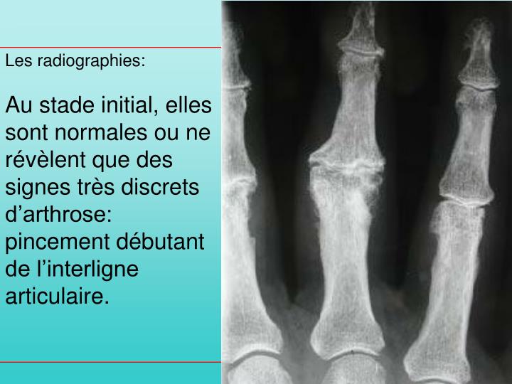 PPT - L’arthrose digitale PowerPoint Presentation - ID:910957