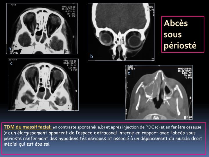 PPT - IMAGERIE DES COMPLICATIONS ORBITAIRES DE LA PATHOLOGIE NASO ...