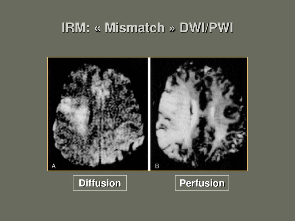 PPT - ACCIDENT VASCULAIRE CEREBRAL : QUELLE PLACE POUR LA FIBRINOLYSE ...