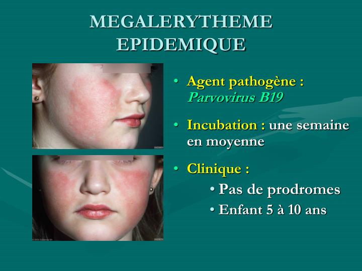PPT - VIROSES A EXPRESSION CUTANÉE Dr L. TAIBI / DERMATOLOGIE CHU ...