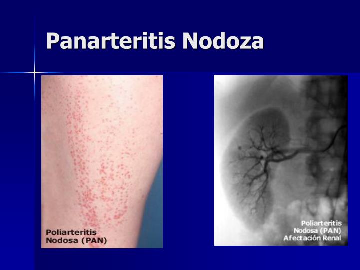 PPT - VASCULITIS PowerPoint Presentation - ID:920958