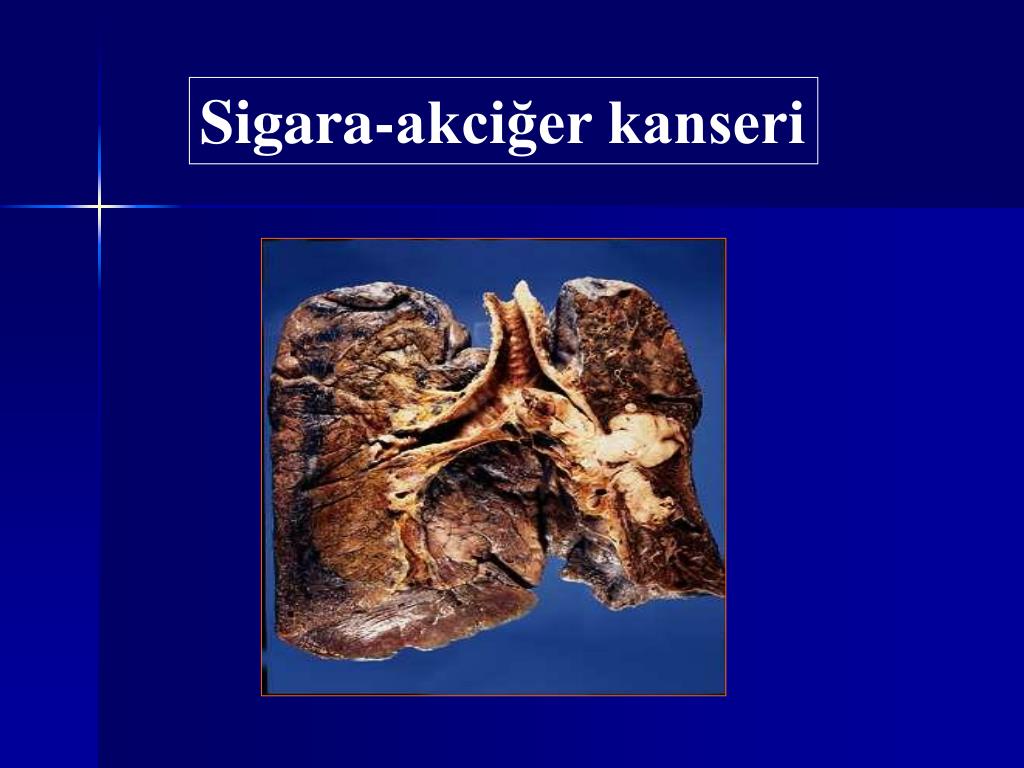 PPT - SİGARANIN ZARARLARI ve SİGARA BIRAKMA YÖNTEMLERİ PowerPoint ... PPT - SİGARANIN ZARARLARI ve SİGARA BIRAKMA YÖNTEMLERİ PowerPoint ...