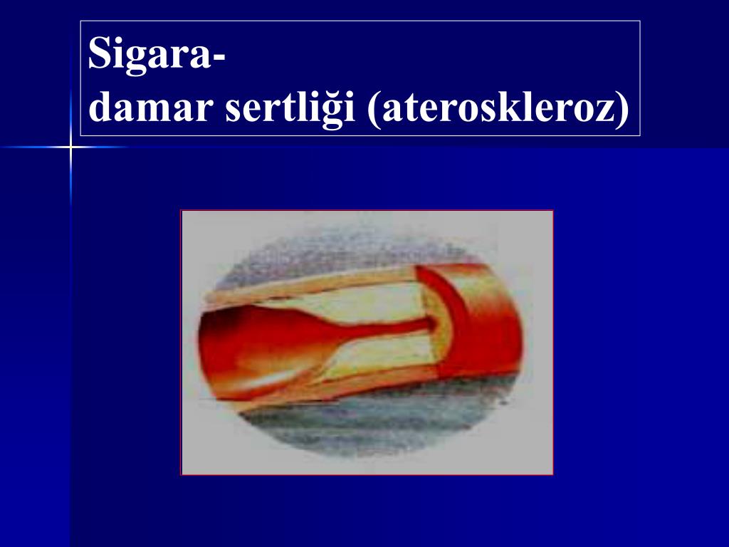 PPT - SİGARANIN ZARARLARI ve SİGARA BIRAKMA YÖNTEMLERİ PowerPoint ... PPT - SİGARANIN ZARARLARI ve SİGARA BIRAKMA YÖNTEMLERİ PowerPoint ...