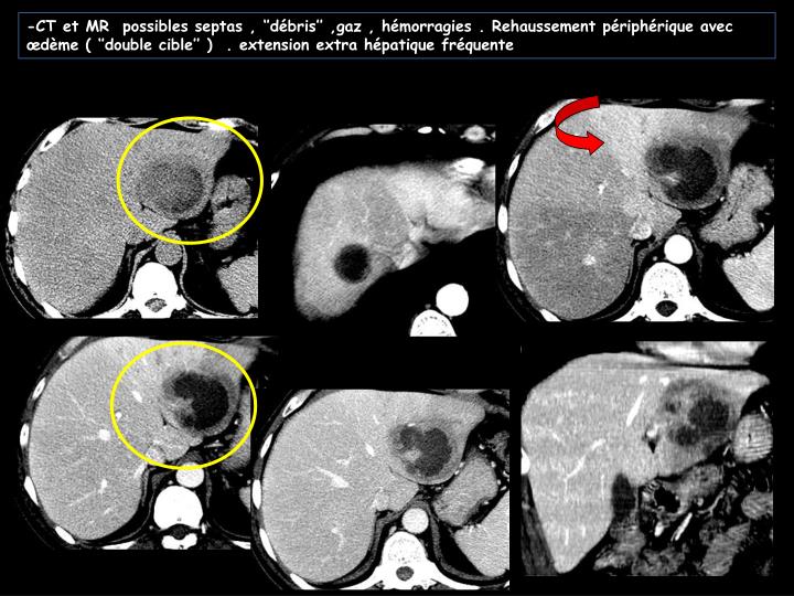 PPT - Imagerie des infections hépato-biliaires PowerPoint Presentation ...