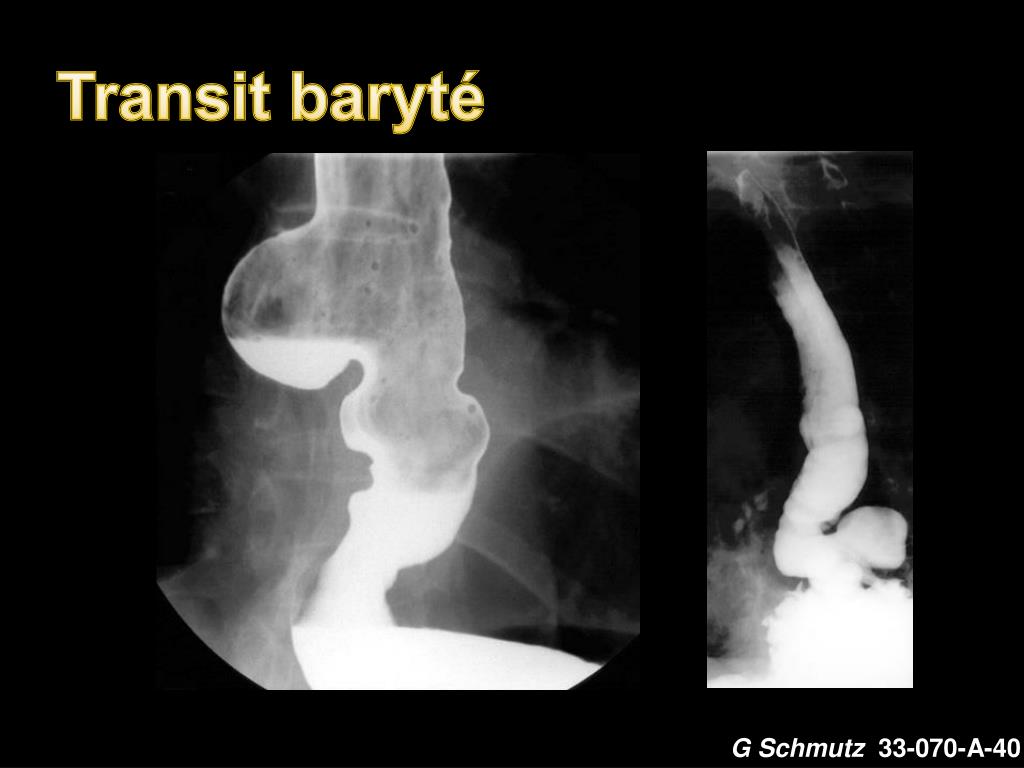 PPT - Diverticules de l’œsophage en dehors du Zenker PowerPoint ...