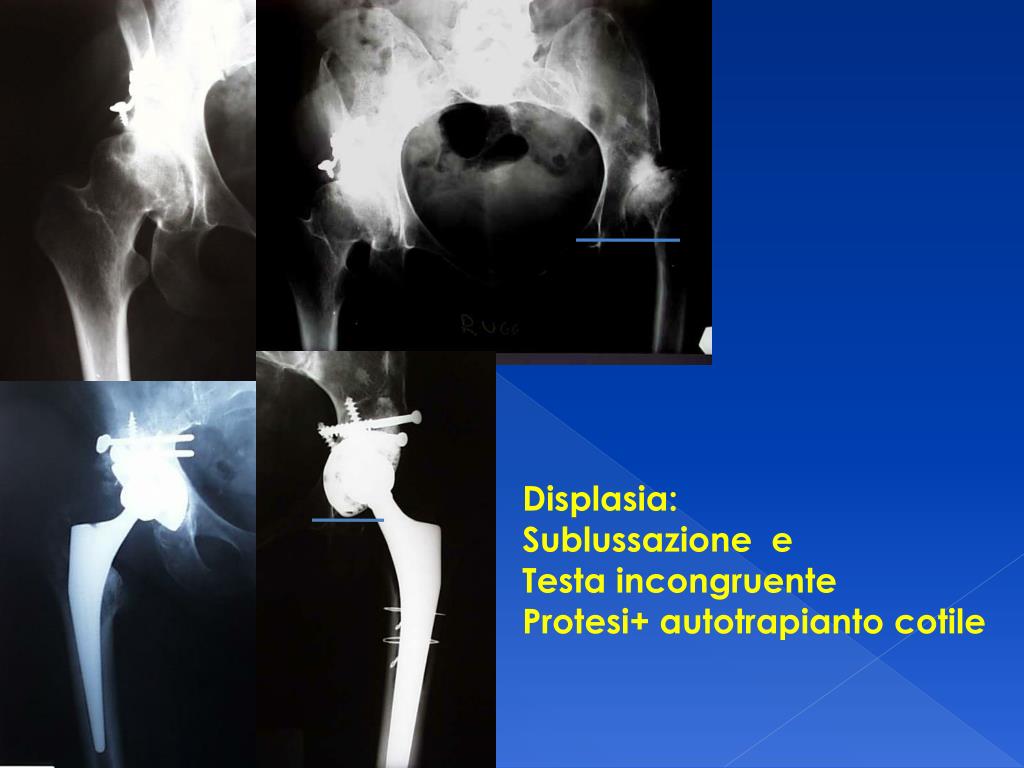 PPT - L’Artrosi: patologia di esclusivo interesse specialistico ...