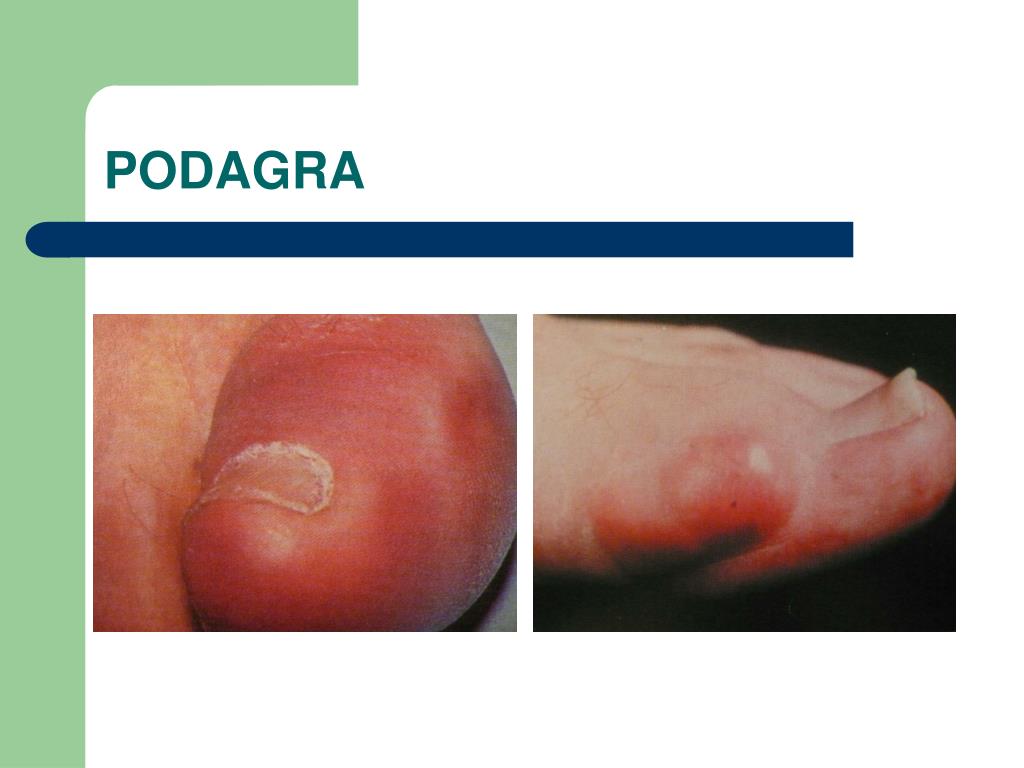 PPT - HIPERURYKEMIA I DNA MOCZANOWA PowerPoint Presentation, free ...