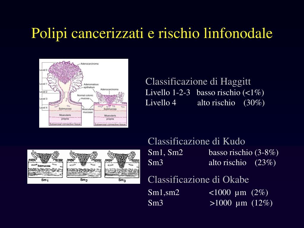 PPT - La chirurgia open vs laparoscopica dei polipi cancerizzati del ...