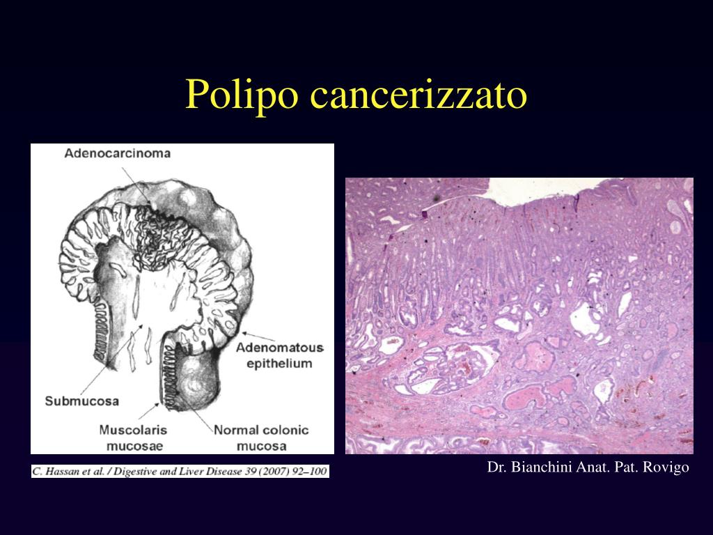 PPT - La chirurgia open vs laparoscopica dei polipi cancerizzati del ...