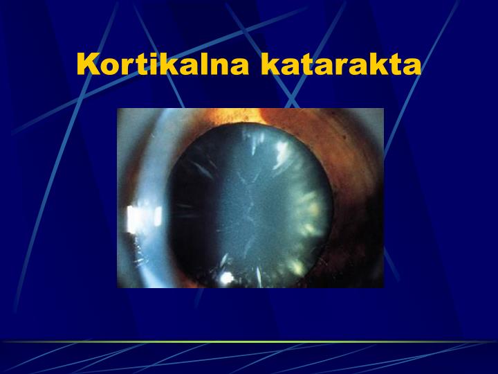 Katarakta