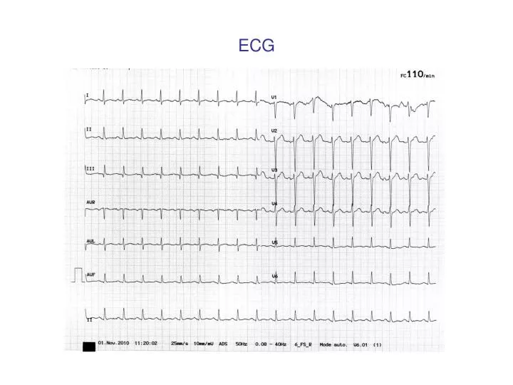 PPT - ECG PowerPoint Presentation, free download - ID:933154