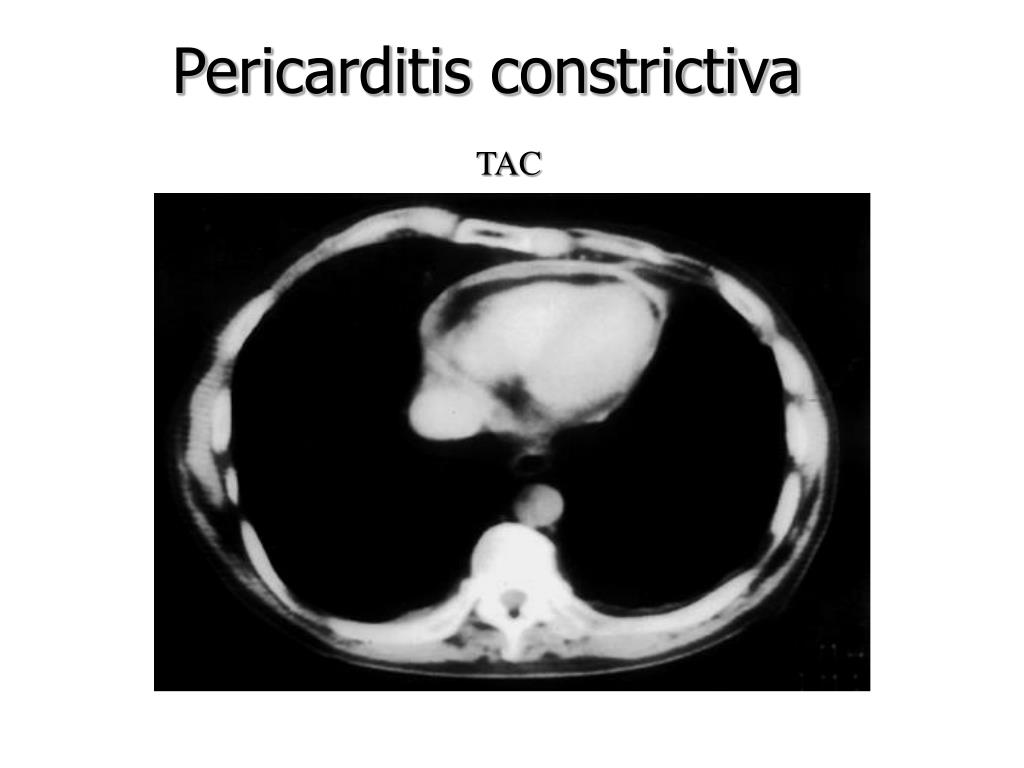 PPT - Patología del pericardio -Diagnóstico -Clasificación -Tratamiento ...