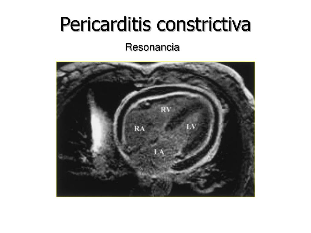 PPT - Patología del pericardio -Diagnóstico -Clasificación -Tratamiento ...