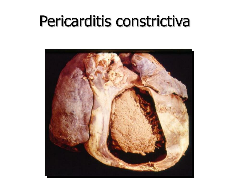 PPT - Patología del pericardio -Diagnóstico -Clasificación -Tratamiento ...
