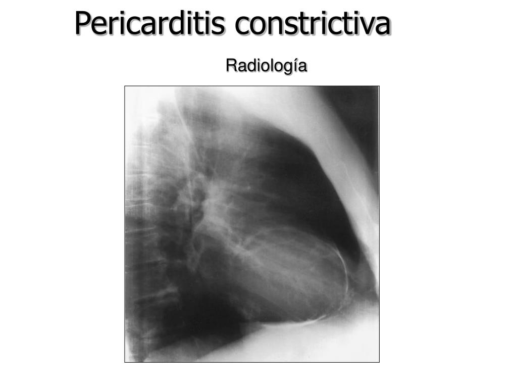 PPT - Patología del pericardio -Diagnóstico -Clasificación -Tratamiento ...