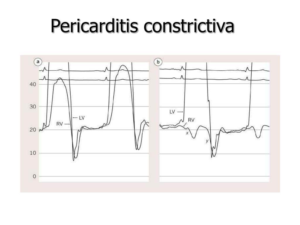 PPT - Patología del pericardio -Diagnóstico -Clasificación -Tratamiento PowerPoint Presentation ...