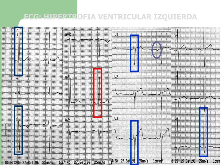 PPT - PREVALENCIA ELECTROCARDIOGRÁFICA DE HIPERTROFIA VENTRICULAR ...