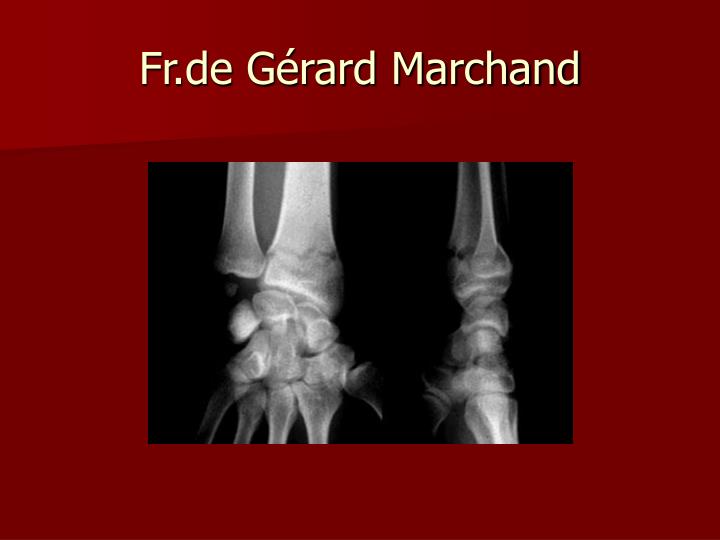 PPT - Fracture de l’extrémité inférieure du radius PowerPoint ...