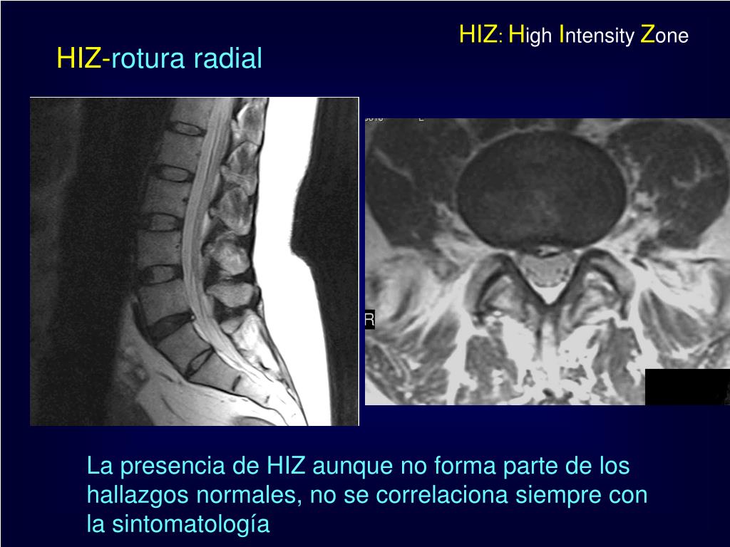 PPT - ENFERMEDAD DEGENERATIVA DEL CANAL LUMBAR PowerPoint Presentation ...