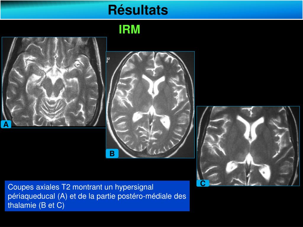 PPT - Apport de l’IRM dans l’encéphalopathie de Gayet-Wernicke ...