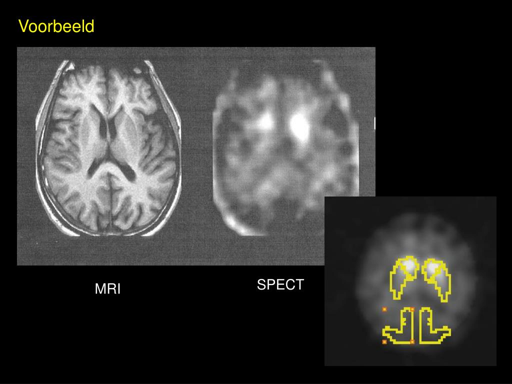 PPT - SPECT scans bij M. Parkinson PowerPoint Presentation, free ...