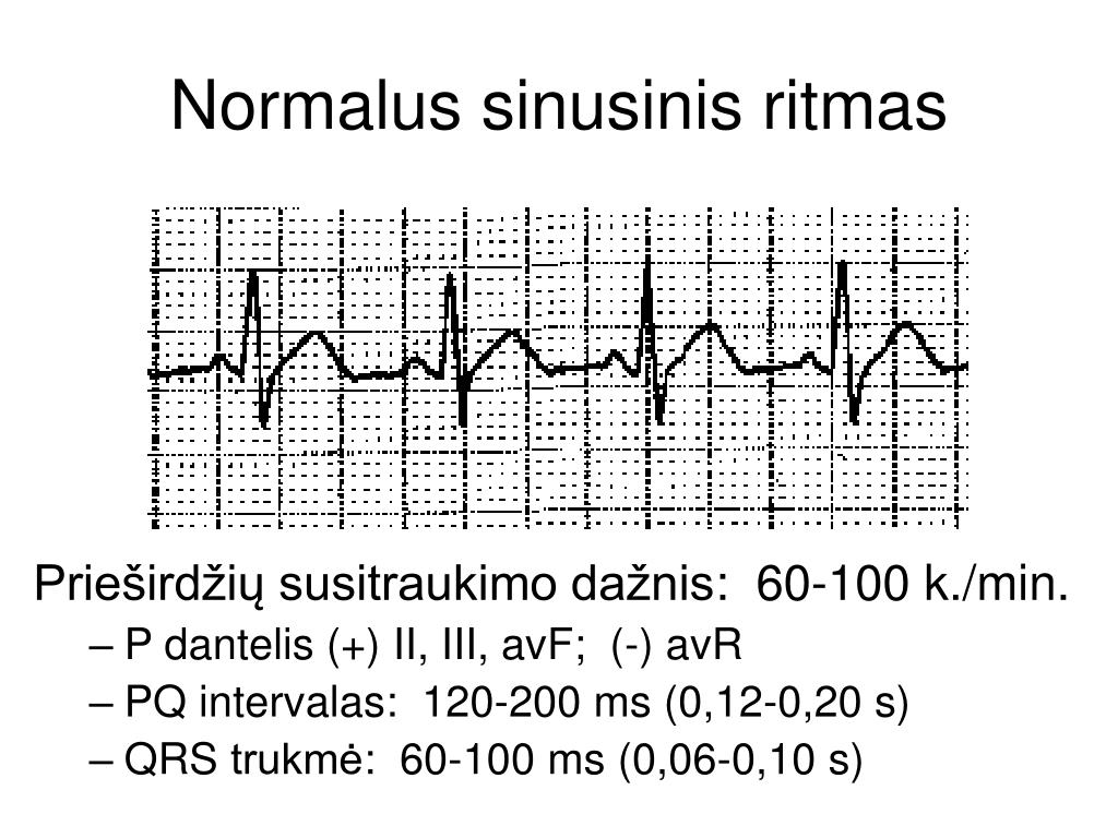 PPT - Elektrofiziologinio tyrimo reikšmė nustatant ir gydant ...