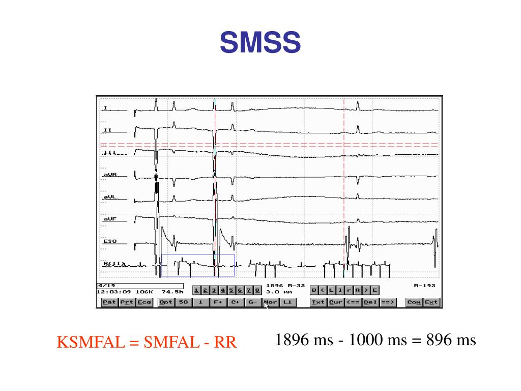 PPT - Elektrofiziologinio tyrimo reikšmė nustatant ir gydant ...