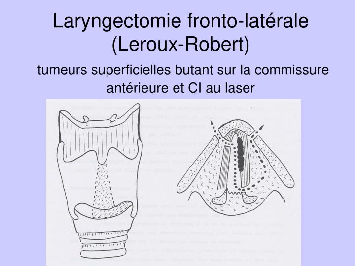 PPT - Cancer du larynx et chirurgie partielle PowerPoint Presentation ...