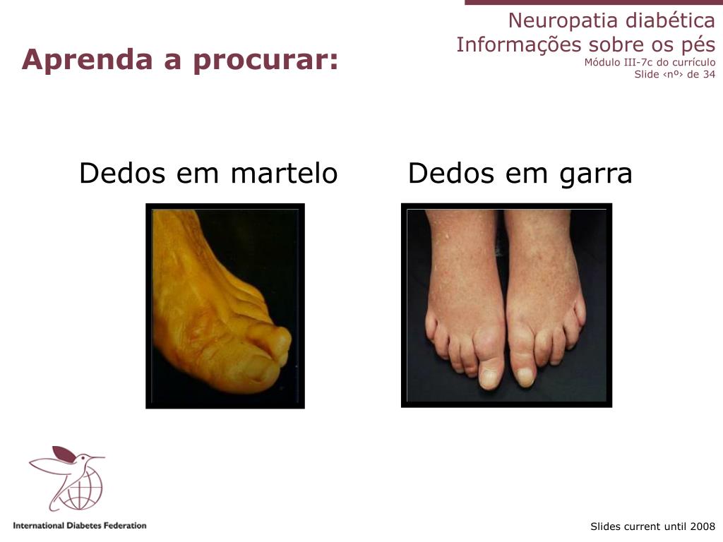 PPT - Neuropatia diabética Informações sobre os pés PowerPoint ...